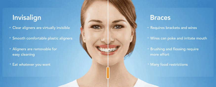 Dentist Best Dental Clinic in Vasundhara: What are Invisible Braces ...