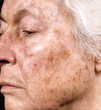 USMLE Review Notes: Photoaging