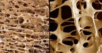 Markers of bone formation and resorption: high yield points and mnemonic