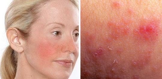 Cara Mengatasi Iritasi Kulit Pada Wajah ~ Glucoberry Asli Dan Murah