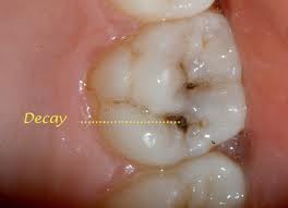 FAMILY CARE DENTAL: FISSURE SEALANTS