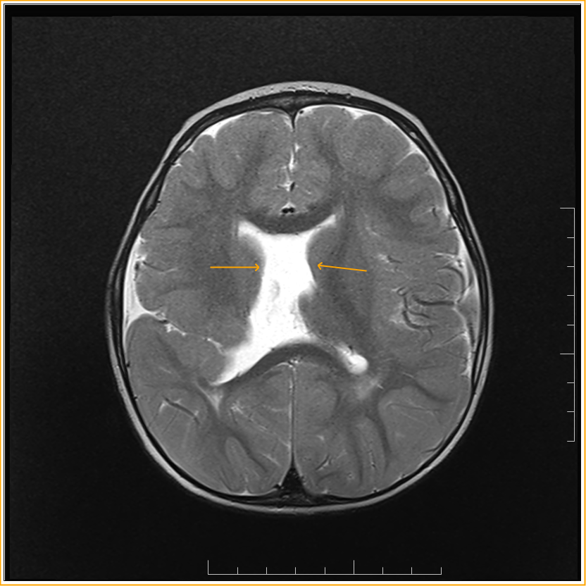 Unilateral Closed Lip Schizencephaly with Septo-Optic Dysplasia - Sumer ...