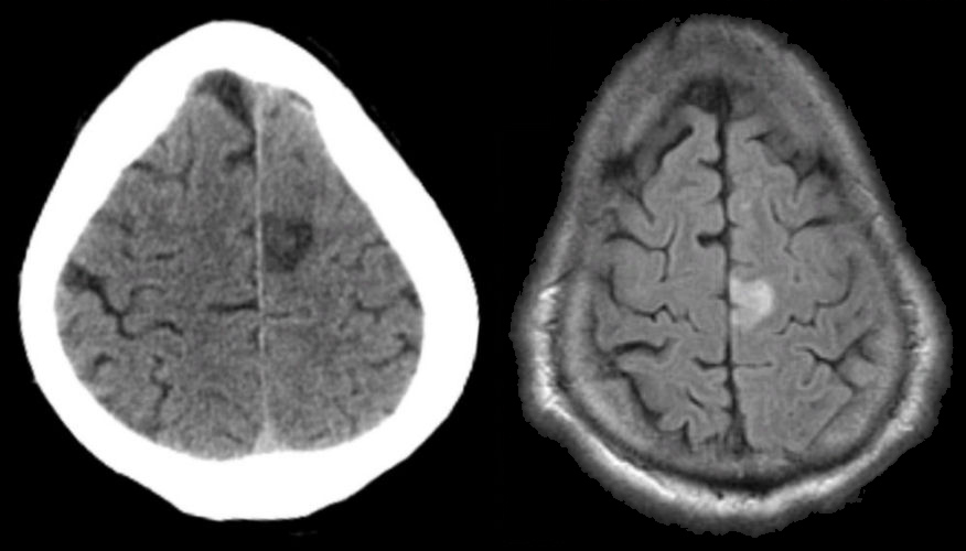 Dr Balaji Anvekar FRCR: Ischemic stroke and Vascular territories of Brain