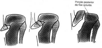 FisioJovem: DOENÇA DE OSGOOD - SCHLATTER E CONDROMALÁCIA PATELAR