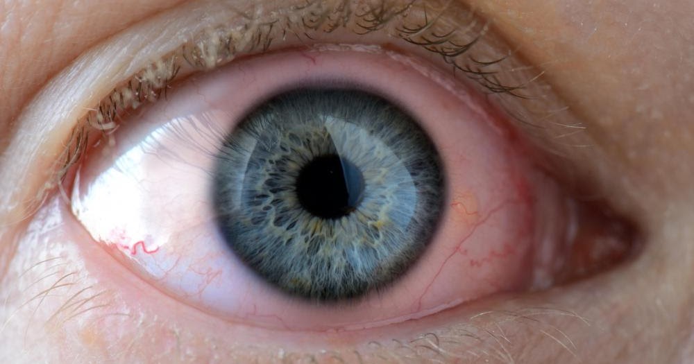 Hypopyon - Definition, Symptoms, Causes, Treatment - Health Care Tips ...