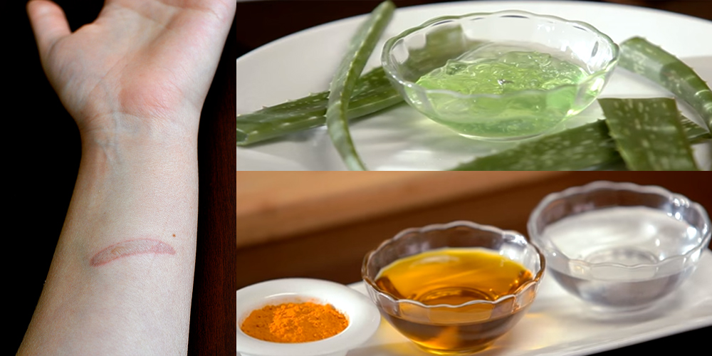 How to Get Rid of Burns and Burn Scars at Home | Life With Styles
