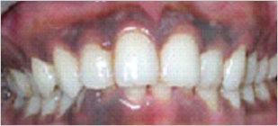 Lead Poisoning Gums Biting Into Dental Fillings | Office For Science