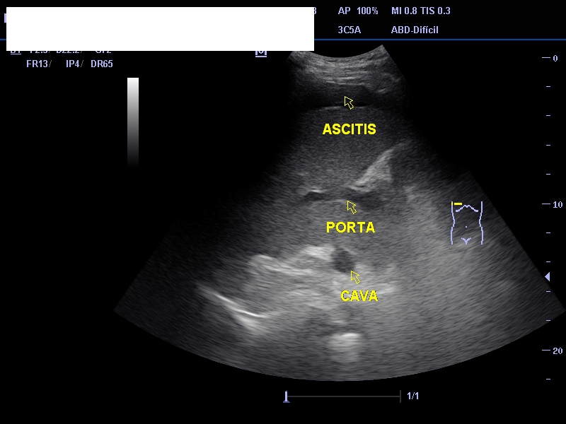 EcoCyl-Grupo: Ascitis