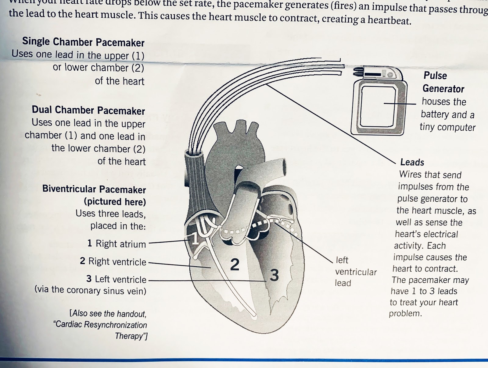 On Pace at 50: Getting a Pacemaker While Young(ish): Third Post: The ...