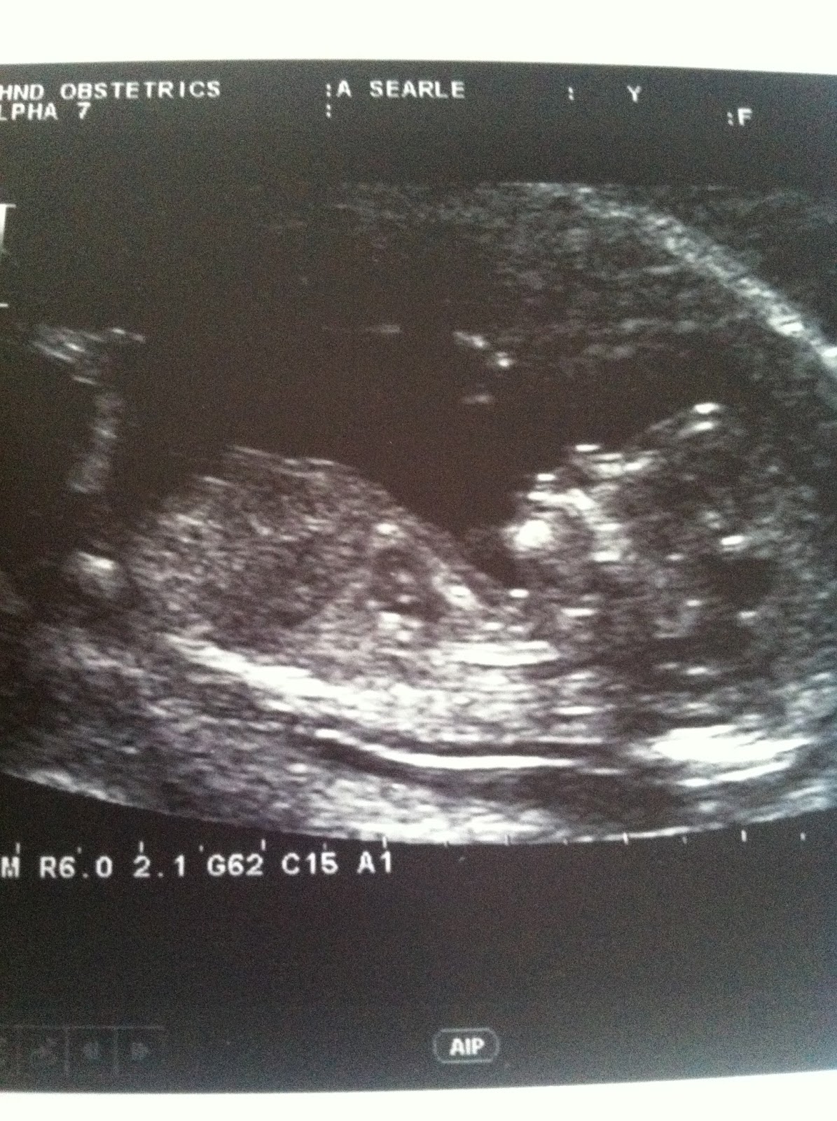 12/13 Weeks Pregnancy Update !!!.....And Scan Picture!! - how about now!?
