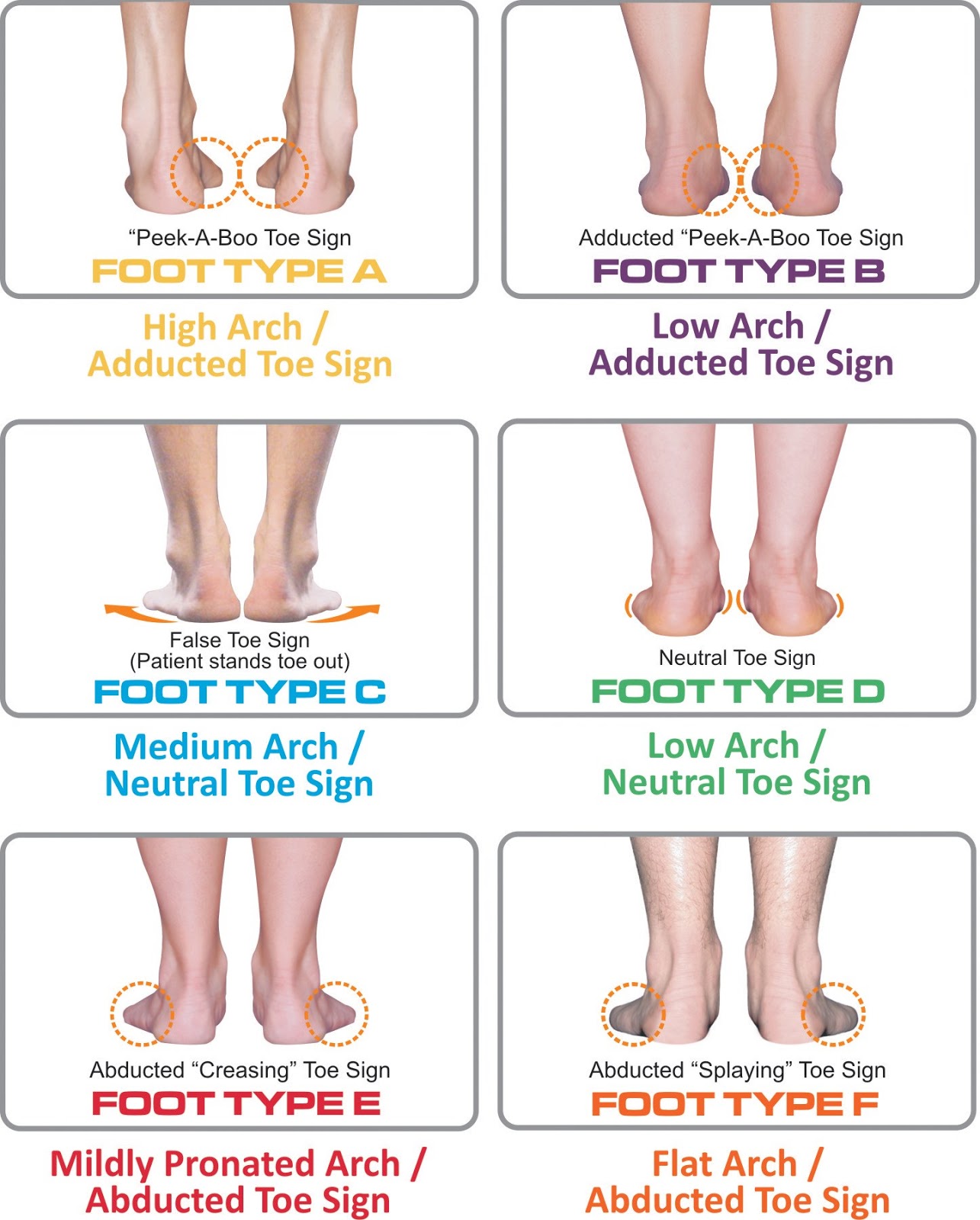 Sunfeet: Jenis Tapak Kaki Punca Sakit Kaki, Badan dan Pinggang
