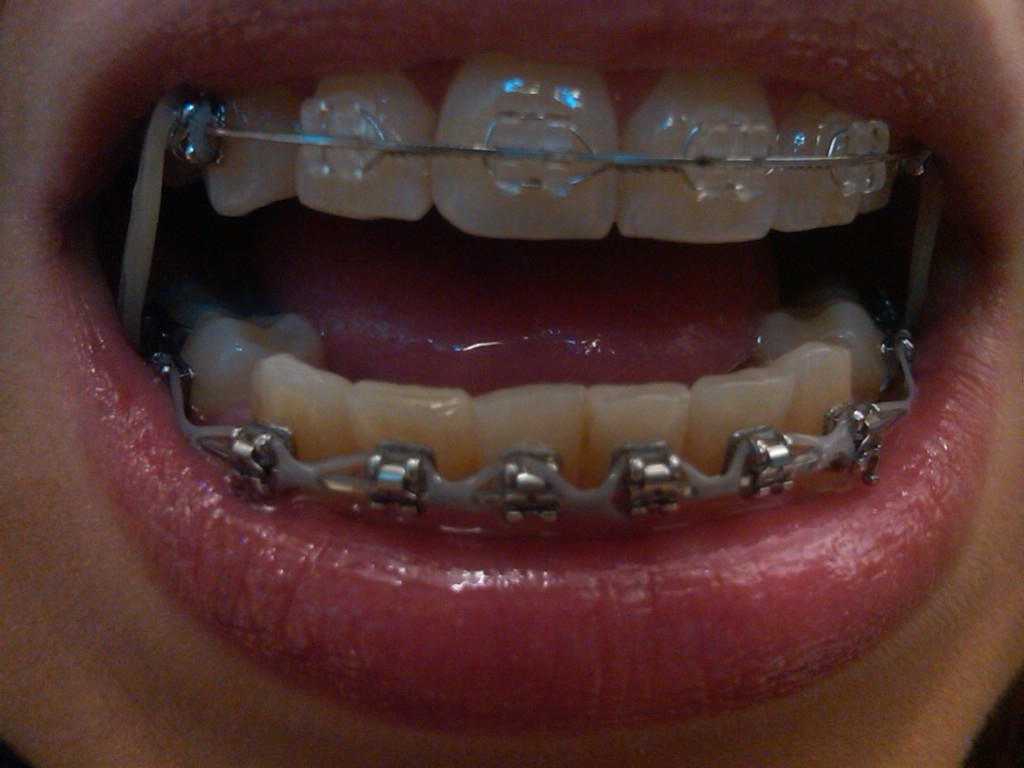 Pretty Little Brace Face