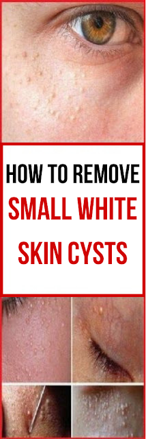 How To Remove Small White Skin Cysts Easily In Home How To Remove Small White Skin Cysts Easily In Home