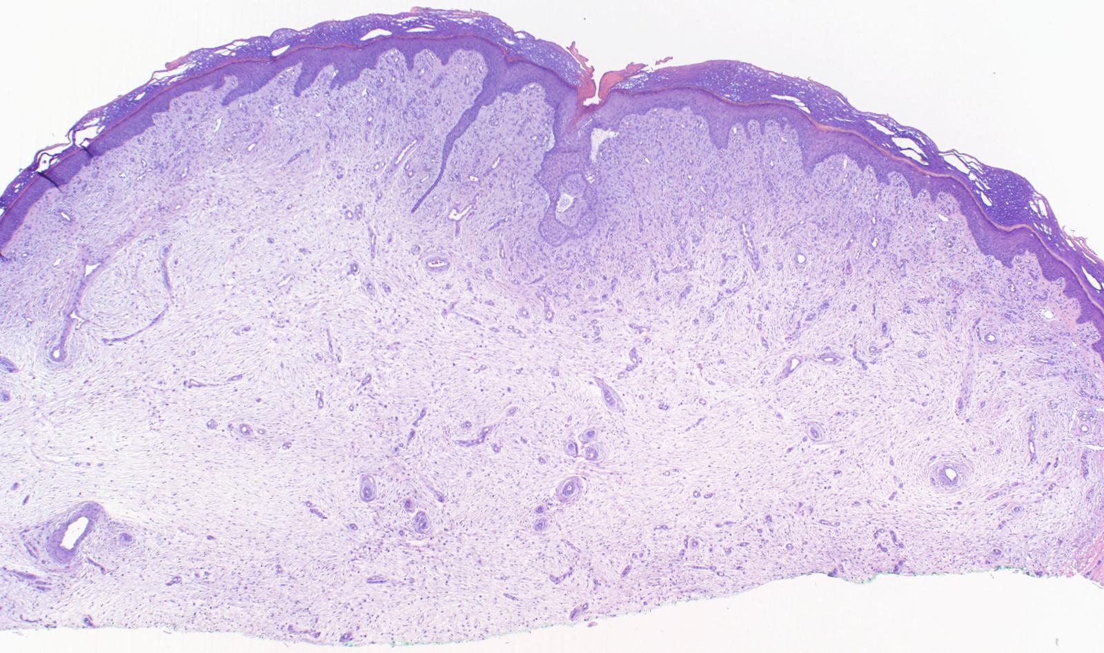 VIRTUAL GRAND ROUNDS IN DERMATOLOGY 2.0: Superficial Acral Fibromyxoma