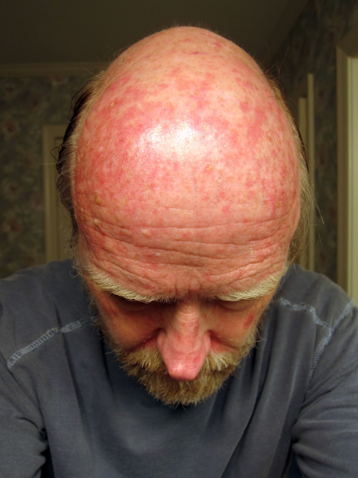 Efudex - Round Two: Day 9 - Starting to Feel the Burn