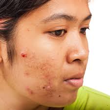 Acne Problems - Causes, Prevention and Best Solution | Lady L Skin ...