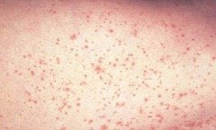 Gejala Demam Berdarah dan Penyebab