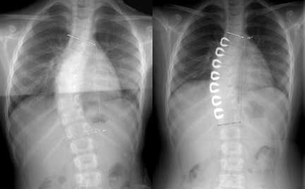 Life with Beals: Surgical Options