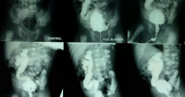 Pediatric Surgery: Vesicoureteral reflux (VUR)