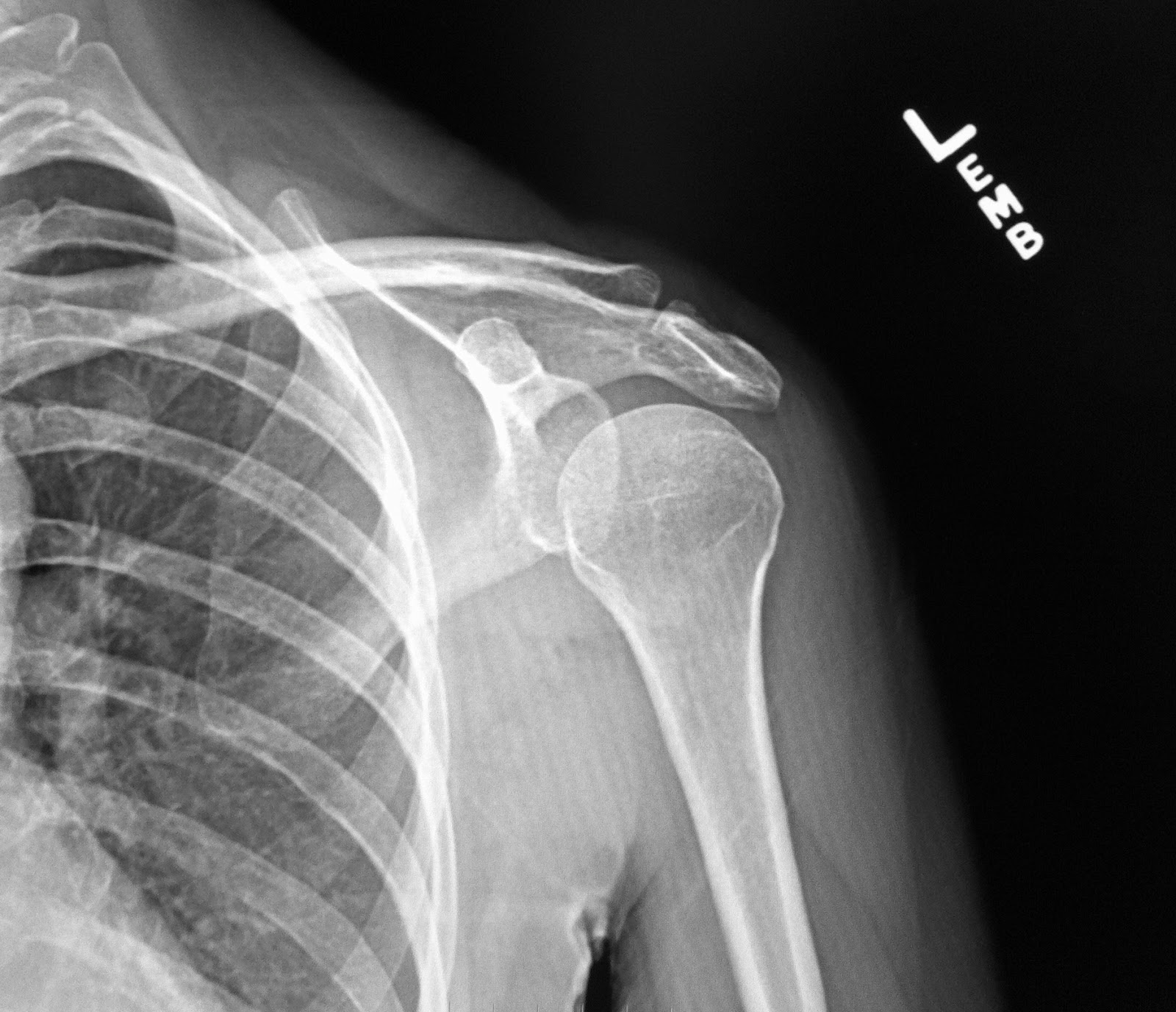 Adhesive Capsulitis Alternative Approach: Radiographs for Adhesive ...