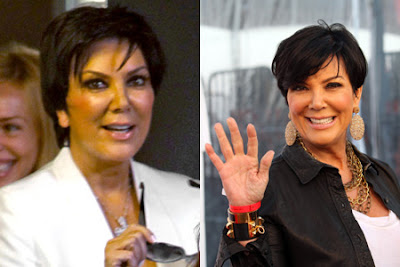 Kris Jenner Plastic Surgery Before and After Botox and new Facelift ...