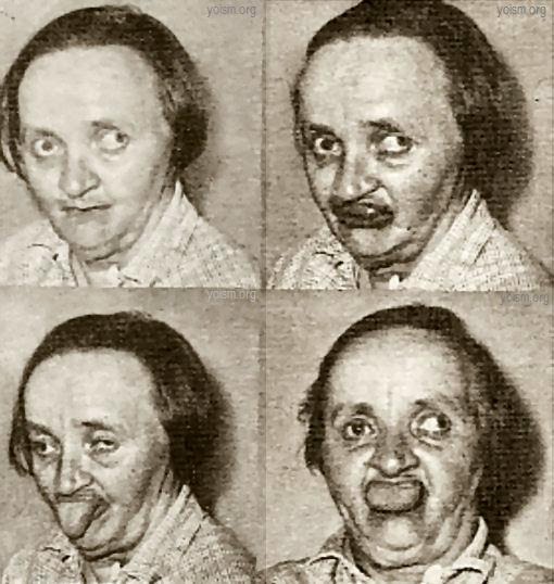 Tardive Dyskinesia Movement Disorder - Disorder Movement