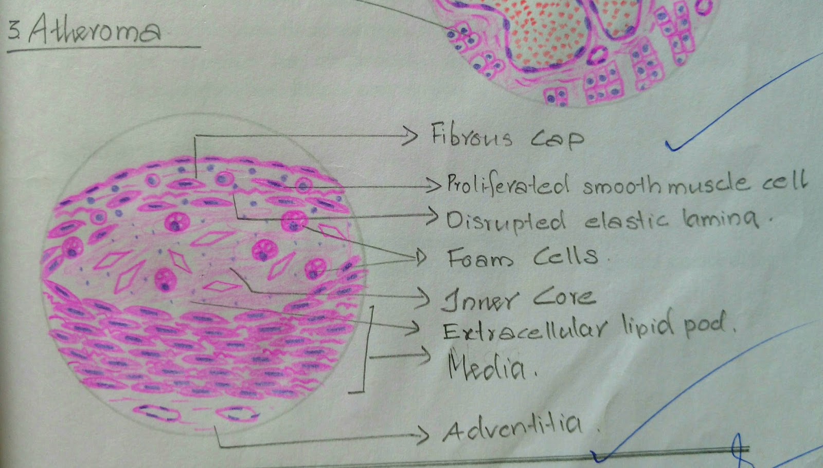Histopathology Drawings: Atheroma