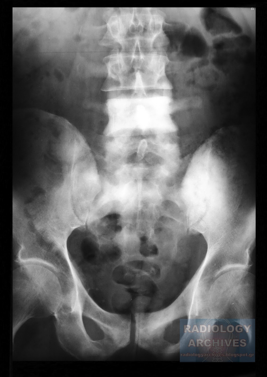 Radiology Archives: Ivory Vertebra Sign (Οστεοβλαστικές Μεταστάσεις ...