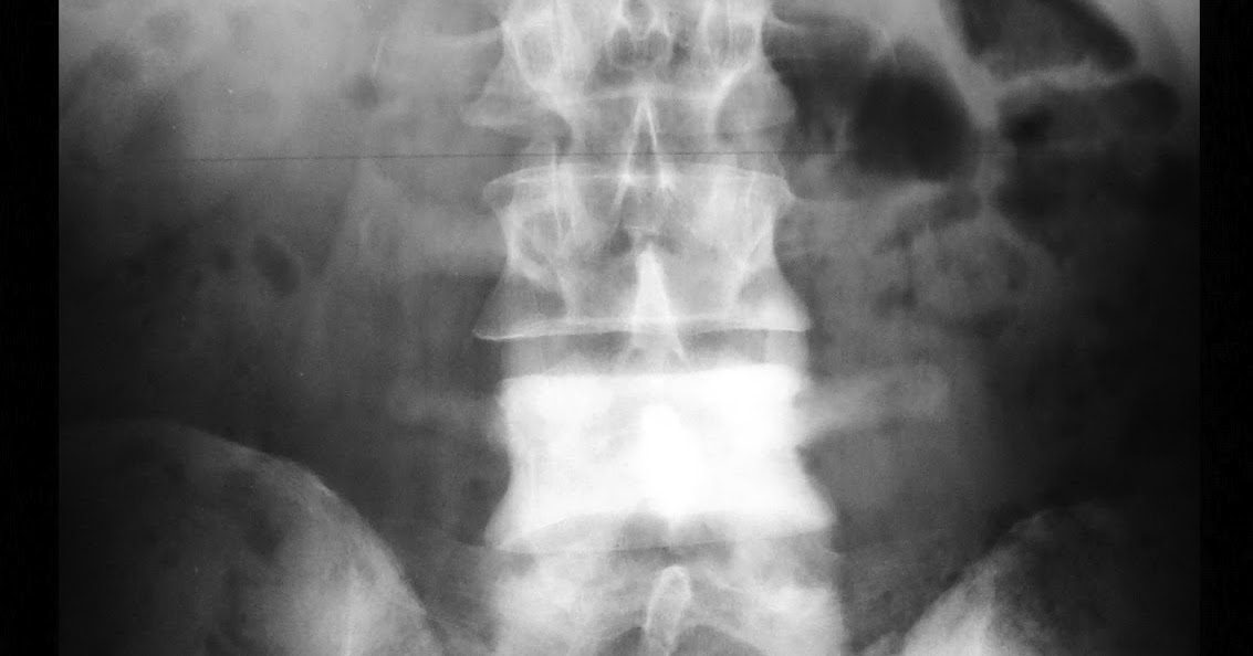 Radiology Archives: Ivory Vertebra Sign (Οστεοβλαστικές Μεταστάσεις ...