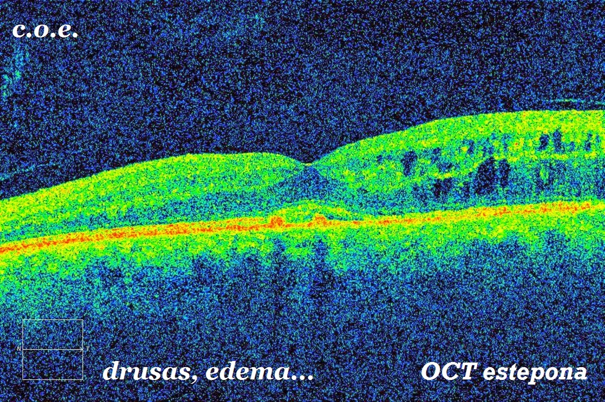 DEGENERACION MACULAR : OCT RETINA