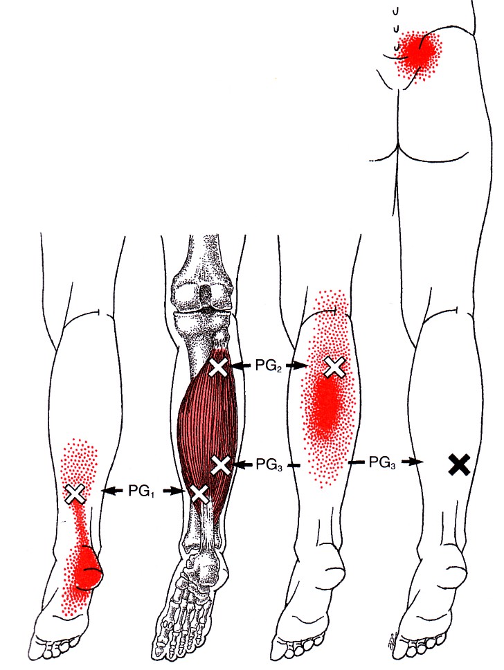 ¿Y A UD. QUE LE DUELE?: FASCITIS PLANTAR - TALALGIA