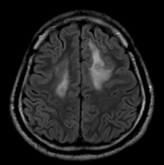 Dengue Hemorrhagic Fever-MRI - Sumer's Radiology Blog