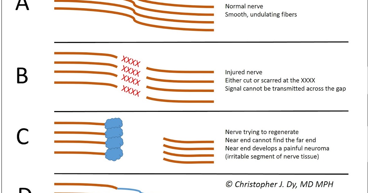 Nerve Conditions and Injuries in the Hand and Arm: Painful neuromas ...