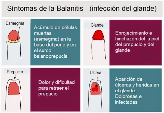 Balanitis aguda
