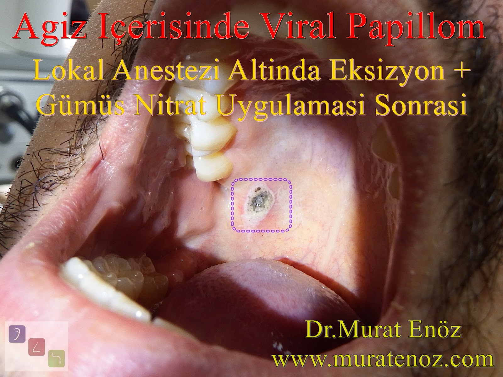 Oral Human Papillomavirus (HPV) Infection - Symptoms, Diagnosis ...
