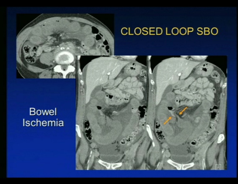 rsna: acute bowel ischemia