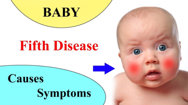 health and fitness: Understanding The Basics of Fifth Disease