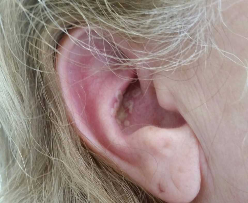 Shingles In Ear