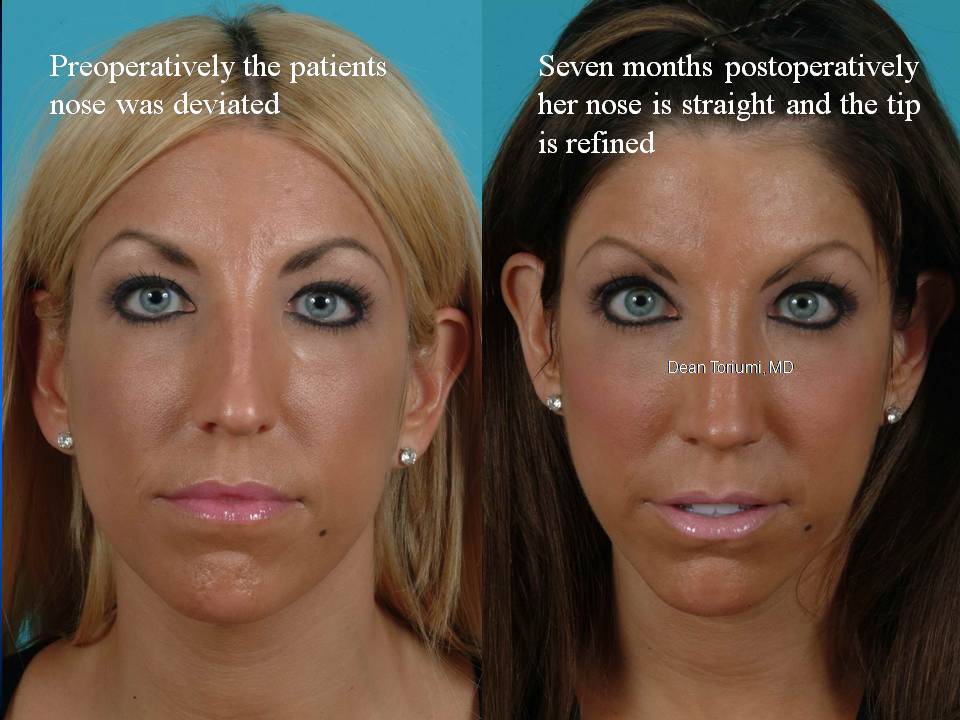 Dr. Dean Toriumi Reviews: Dean Toriumi Reviews: Patient presented with ...