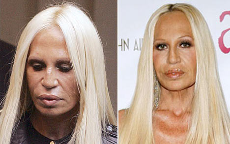 Donatella Versace Surgery