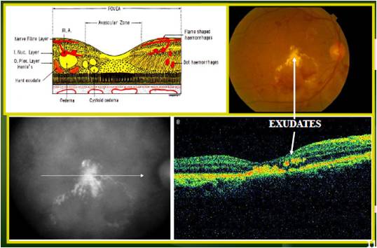 Optometry Education: MACULAR OCT