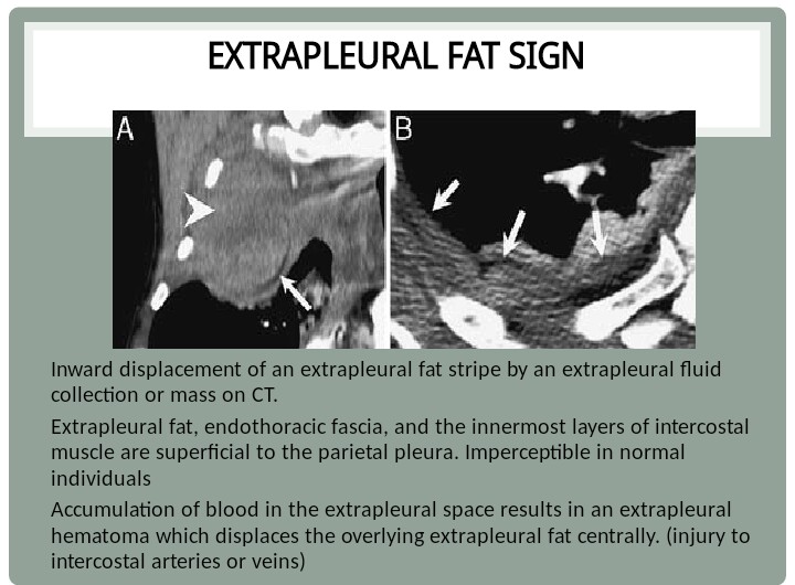 Chest Medicine Made Easy-Dr Deepu: Extrapleural fat sign
