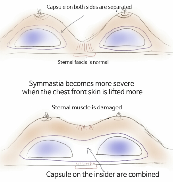 Dr. Lee Breast augmentation Korea: Symmastia(uniboob) after breast ...