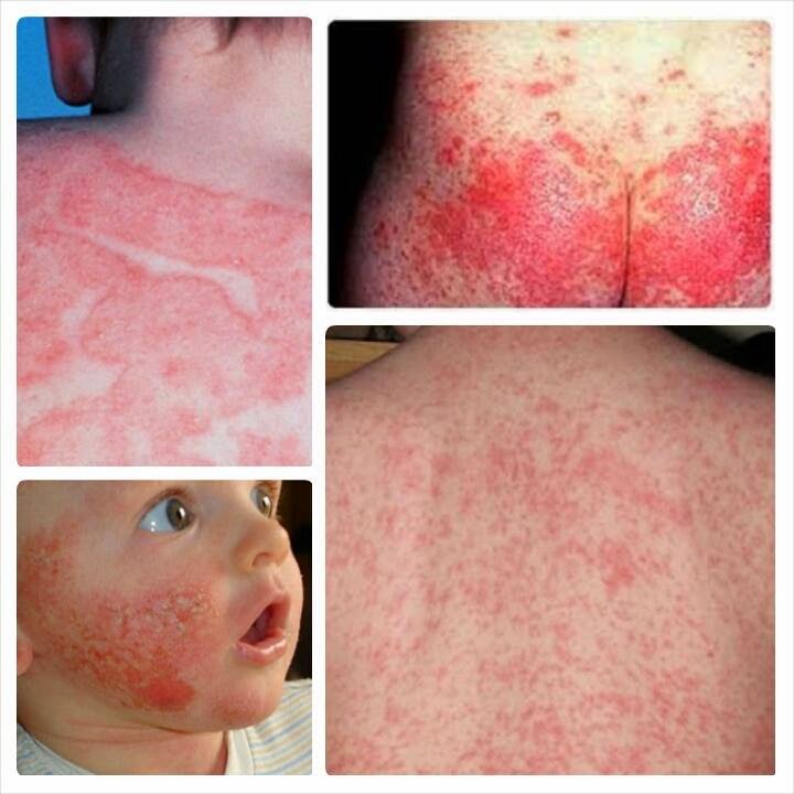 Jom Sihat dan Anggun: Tips Hilangkan Ruam Pada Bayi