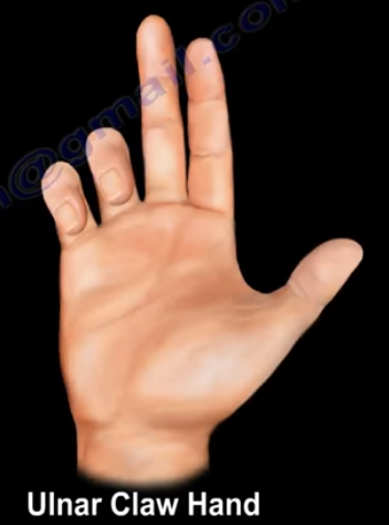 Dr. Nabil Ebraheim's Blogspot: Anterior Interosseous Nerve- The ...