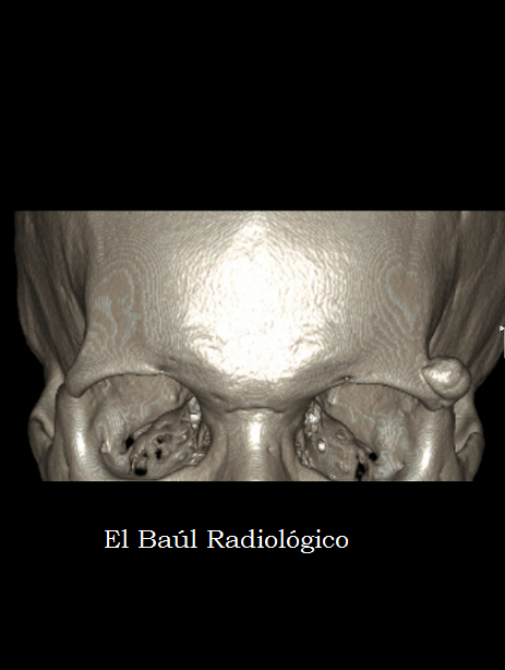 El Baúl Radiológico: OSTEOMAS CRANEALES. (Cranial Osteomas. CT Findings ...