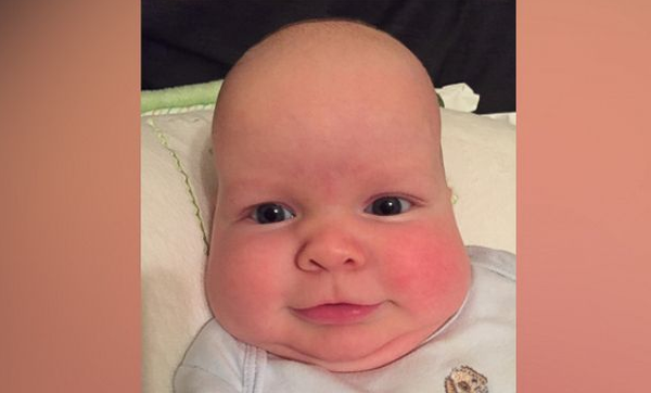 BLOG: Infant's Unusual Head Shape Reveals Dangerous Condition