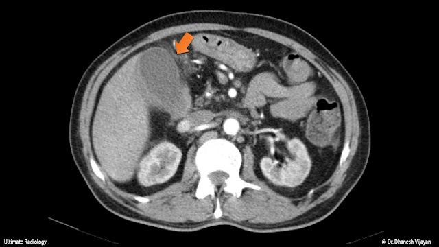 Ultimate Radiology : Acute Cholecystitis with intrahepatic perforation ...
