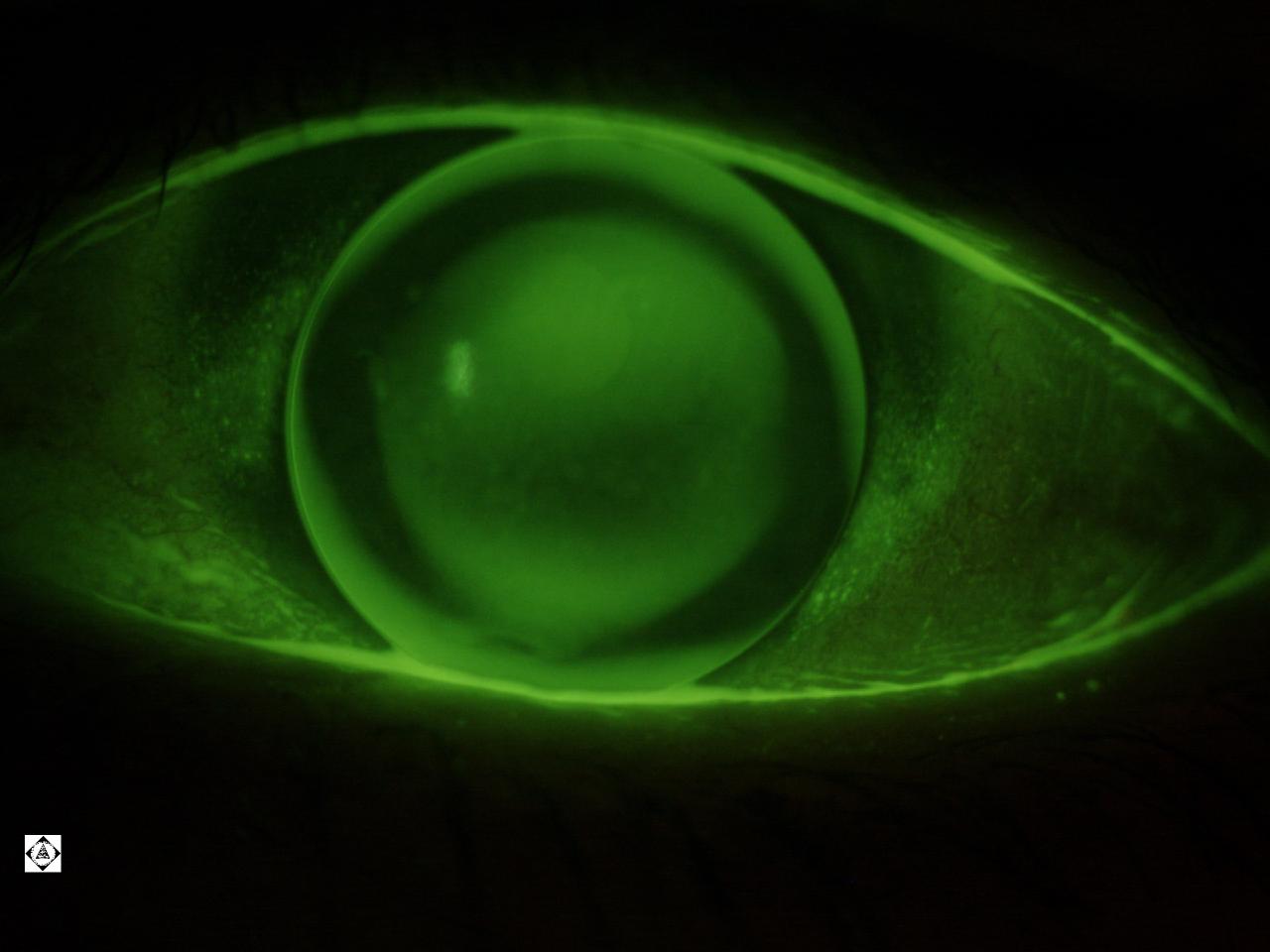 Sonoran Desert Eye Center: 3-9 STAINING FROM IMPROPER RIGID GAS ...