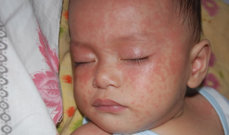 Artikel Kesehatan: Penyakit Campak Pada Anak Dan Pengobatanya